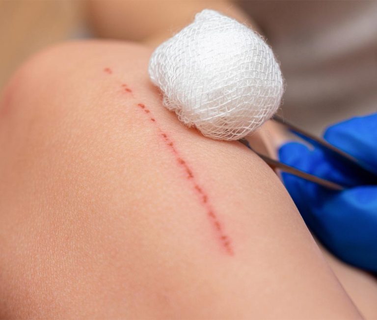Scar Treatment – Athenas Medical Aesthetics